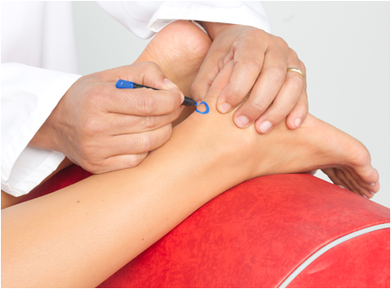Insertional Achilles tendinopathy2 - Maidenhead Podiatry and ...