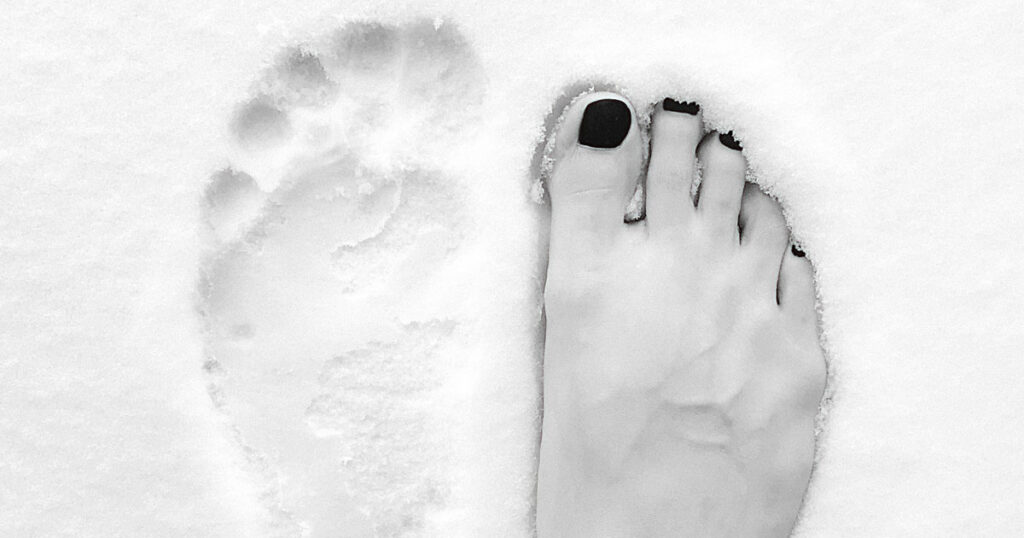 Red, itchy toes? Could it be chilblains? Maidenhead Podiatry ...